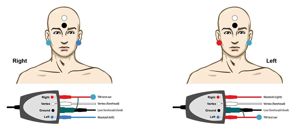 Eclipse | Cochlear Microphonics | Interacoustics